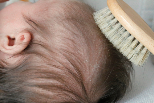 Cradle Cap or Dandruff: A Complete Guide to Understanding Baby's Scalp ...