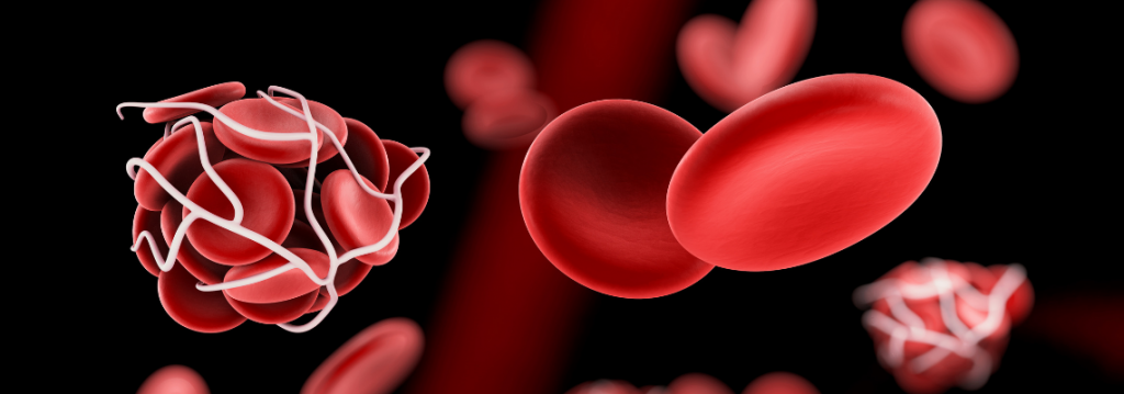 Genetic Blood Clotting Disorder Linked to Miscarriage - Healthy Pregnancy