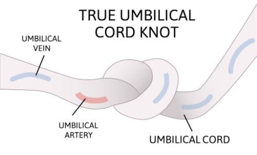 Umbilical Cord Knot: What You Need to Know - Healthy Pregnancy