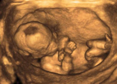 3D and 4D Ultrasounds: Are They Safe? - Healthy Pregnancy